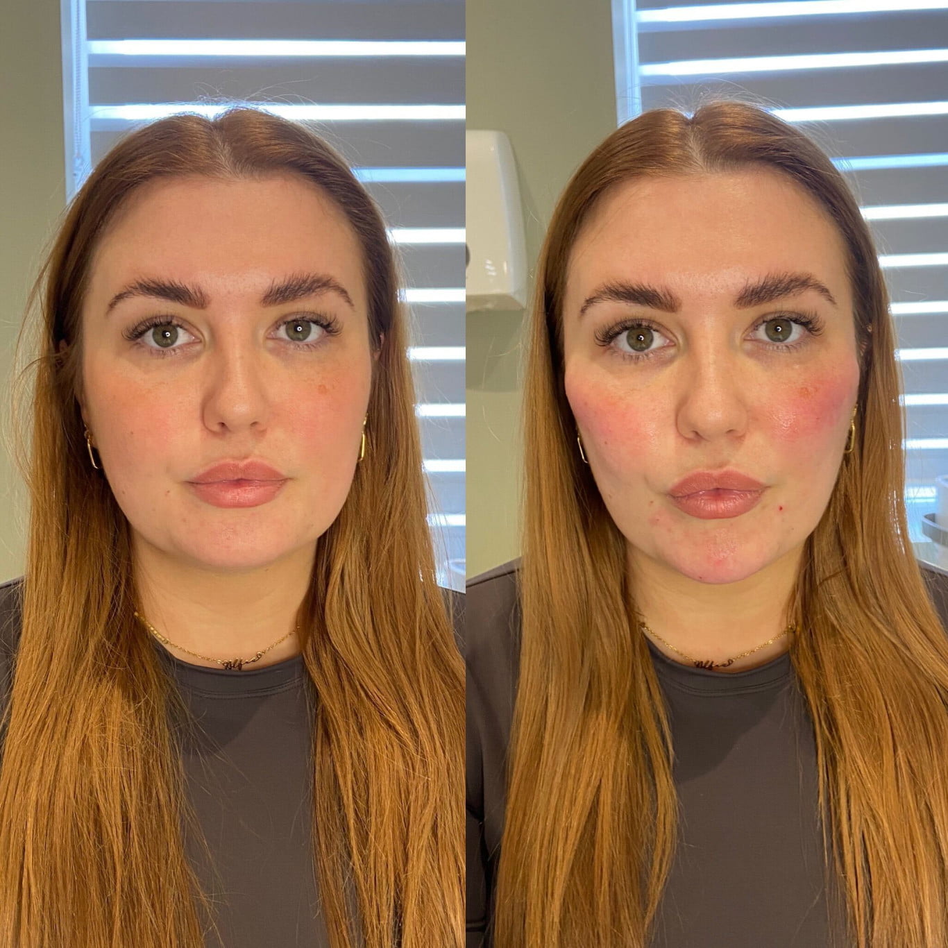Dermal Fillers - The Grange Clinic